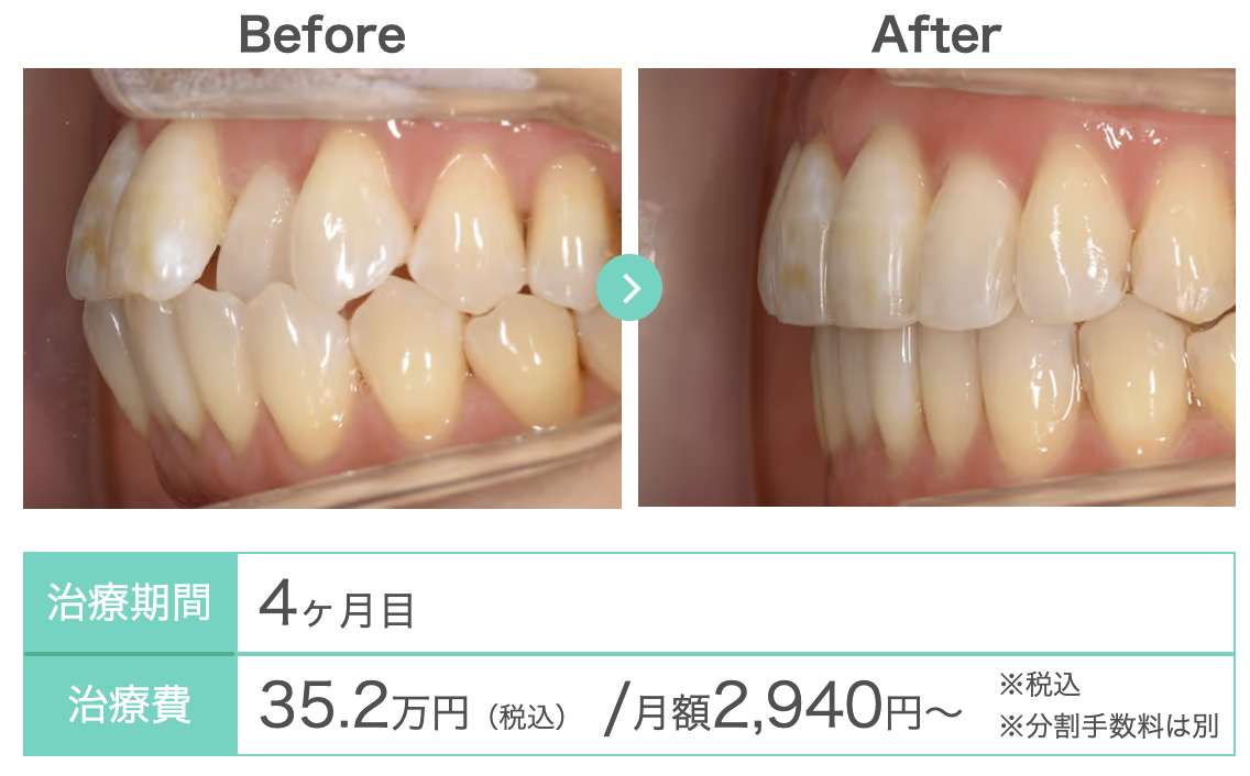 【独自取材】ウィスマイル矯正の口コミ・評判30選！歯科医が感じたリアルやメリット・デメリットも解説 | HANARABIST